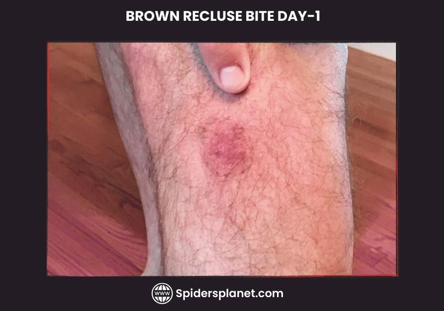 Brown Recluse Spider Bite: Symptoms, Treatment & Preventions